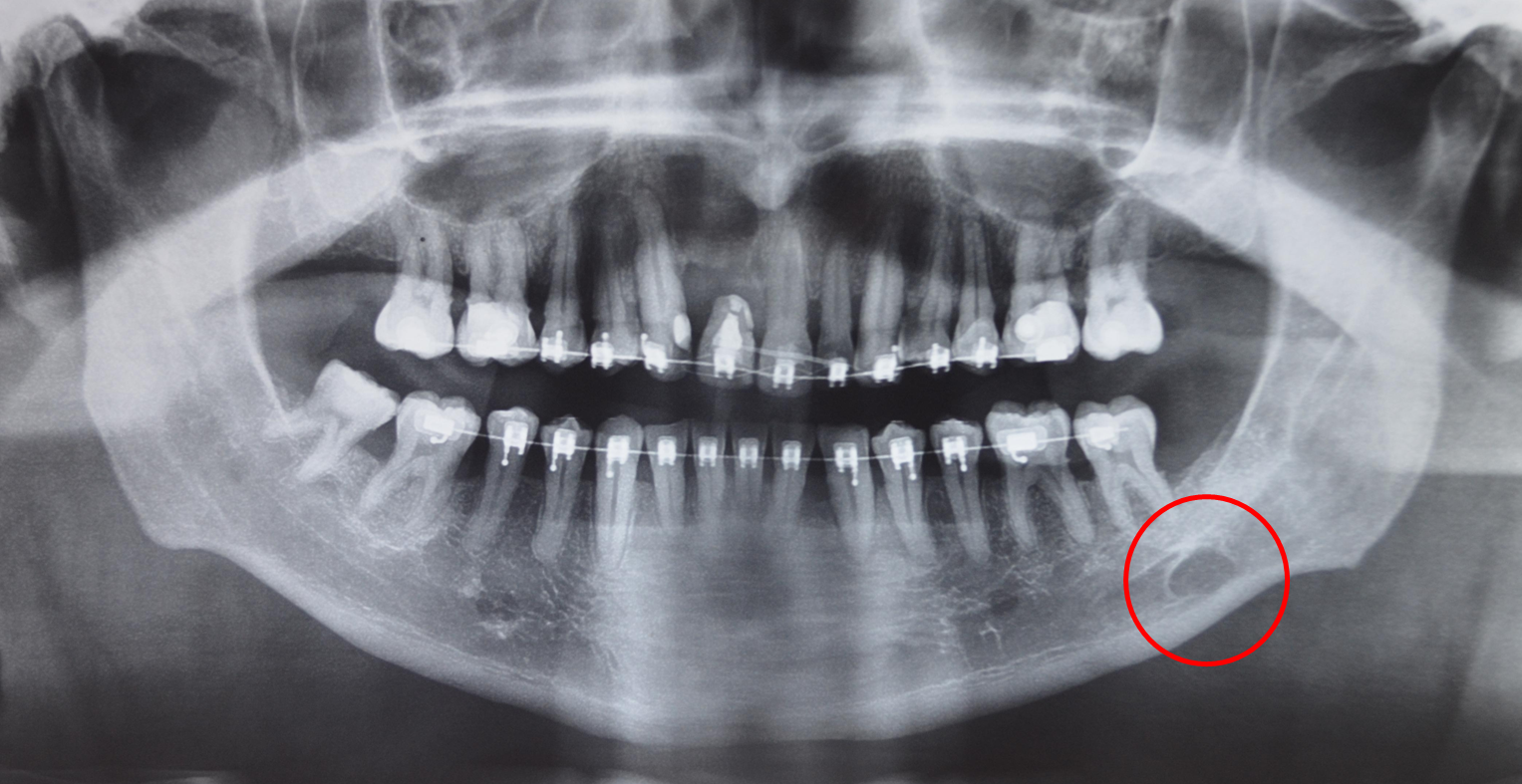 CIDEM: DEFECTO ÓSEO DE STAFNE