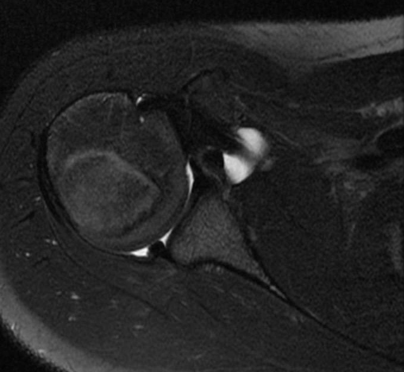 Shoulder and Elbow Surgery: Posterior chondrolabral cleft and recurrent ...