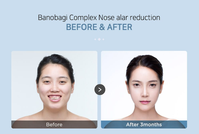Plastic Surgery in Korea : Complex Nose Alar Reduction