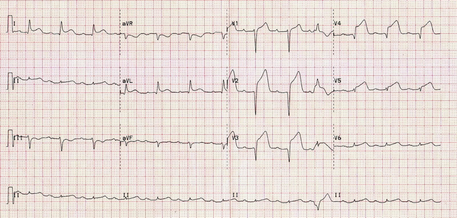 Anterior ST Elevation Myocardial Infarction | INA - ECG