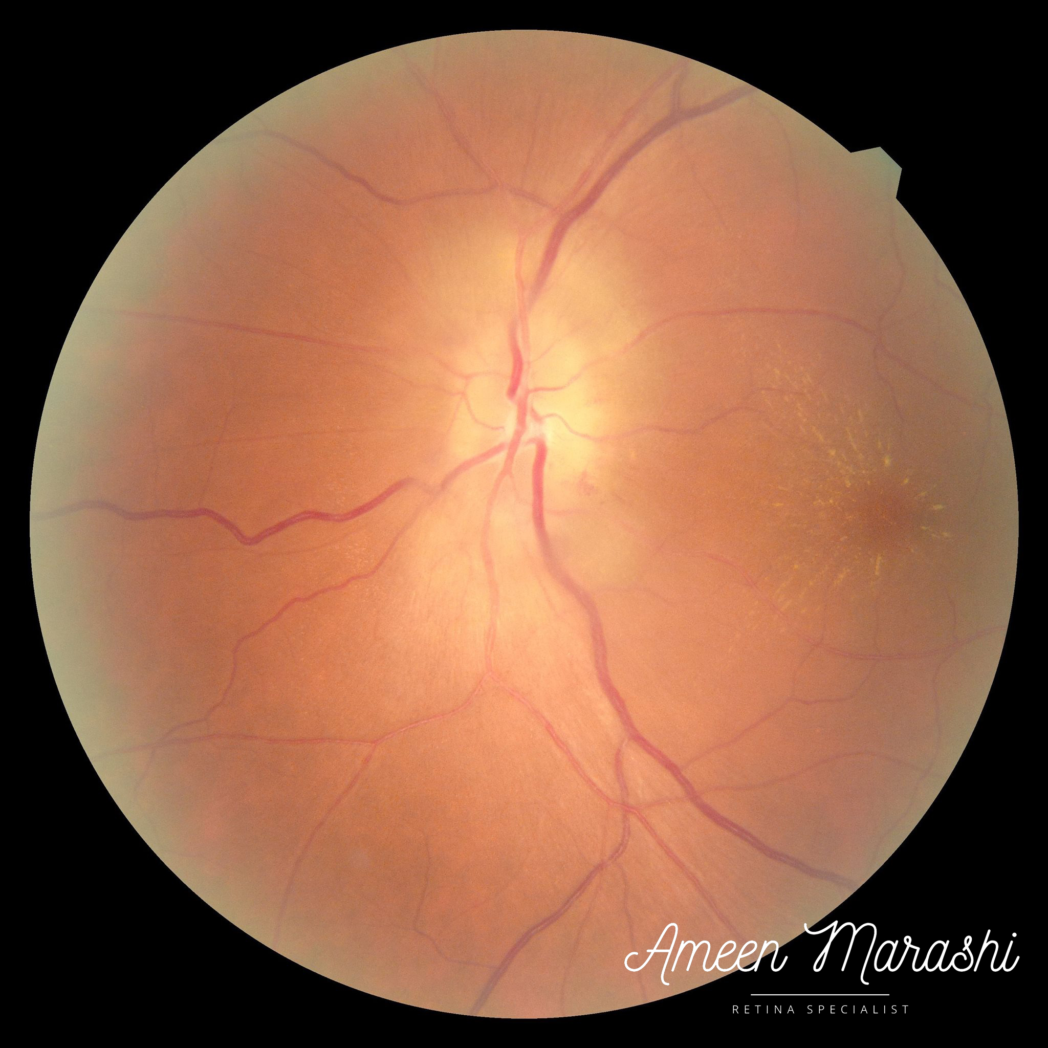 Idiopathic neuroretinitis