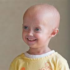 La realidad de la Progeria: Realmente se le denomina Progeria