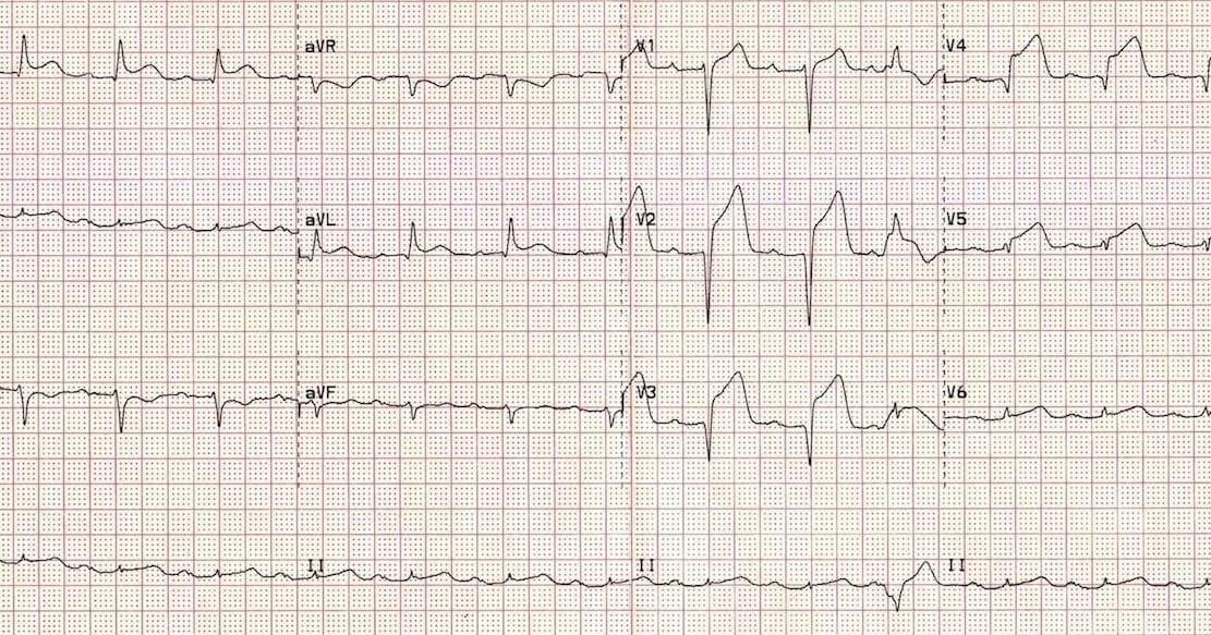 Cardiology window: Anterior wall myocardial infarction with first ...