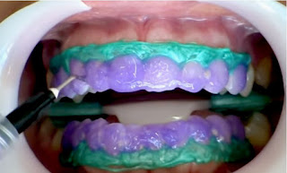 BLEACHING & Internal Bleaching For Supragingival Dentistry