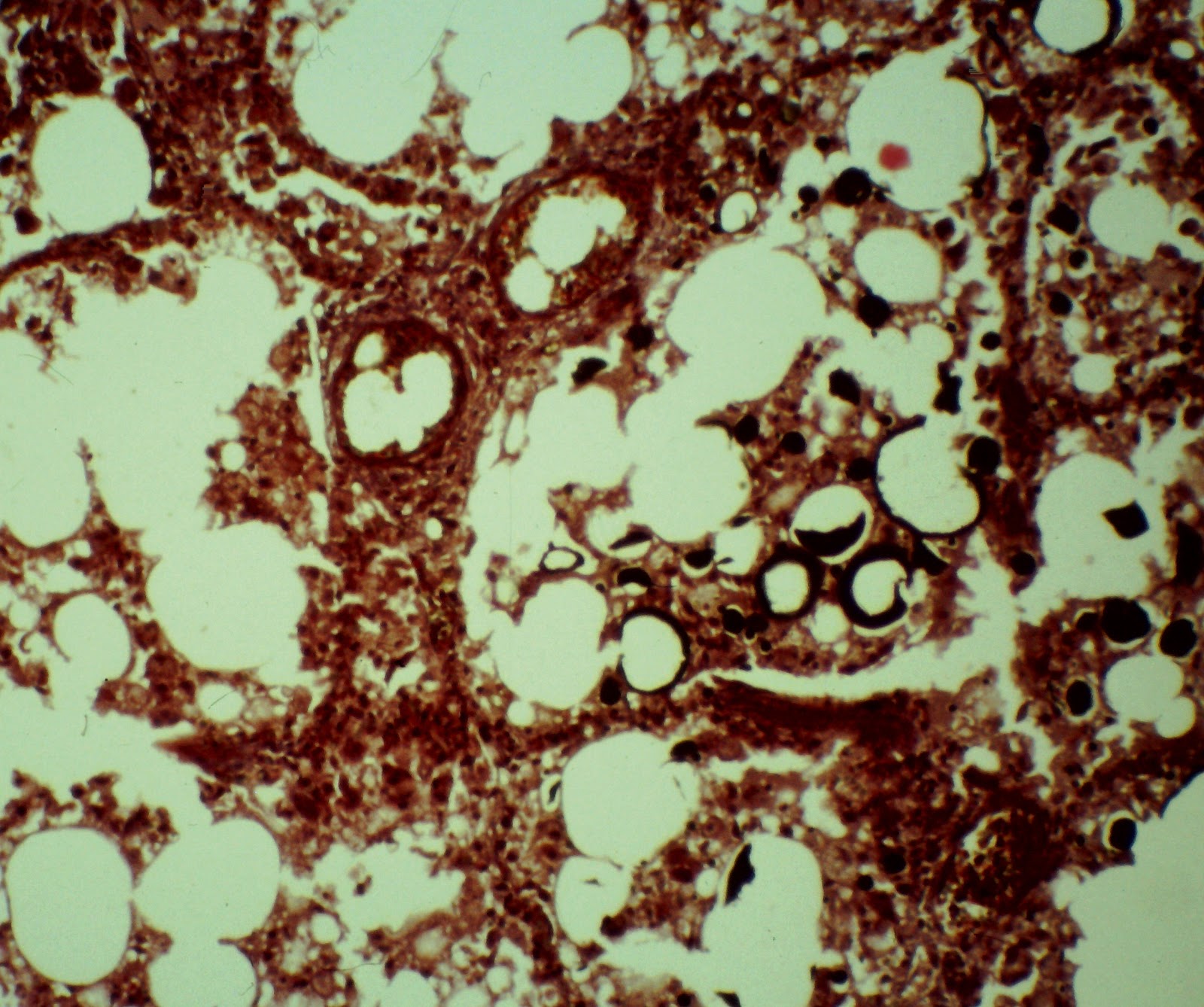 HISTOPATOLOGIA FORENSE PRACTICA (FORENSIC PATHOLOGY FORUM): 126.-ACUTE ...