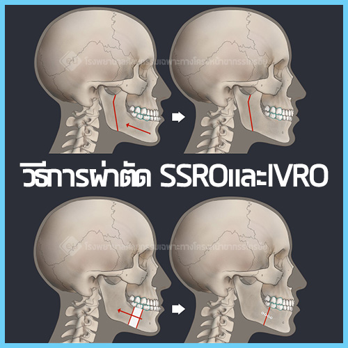 โรงพยาบาลอียู EU Surgery: วิธีผ่าตัด SSRO และ IVRO