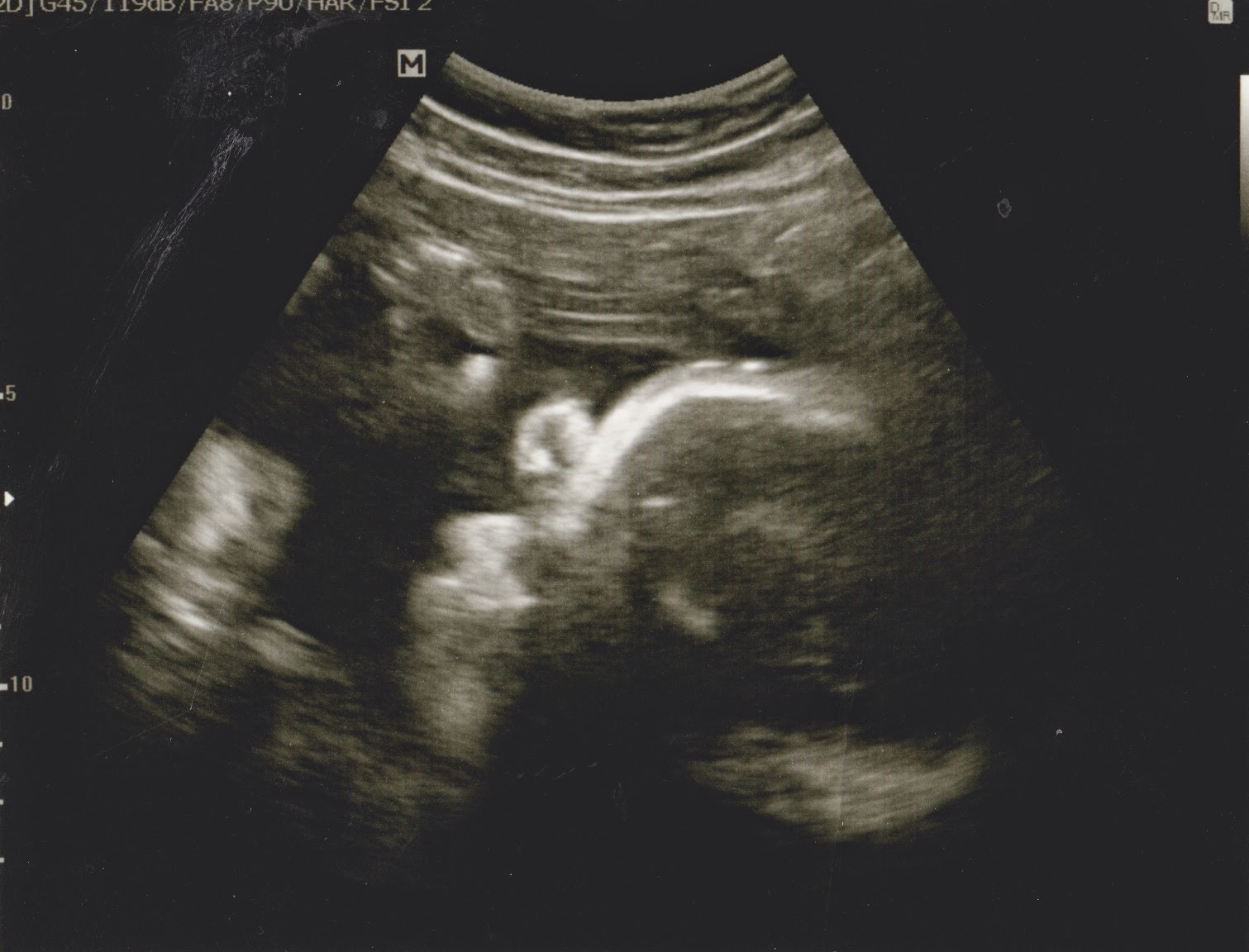 32 Weeks Ultrasound