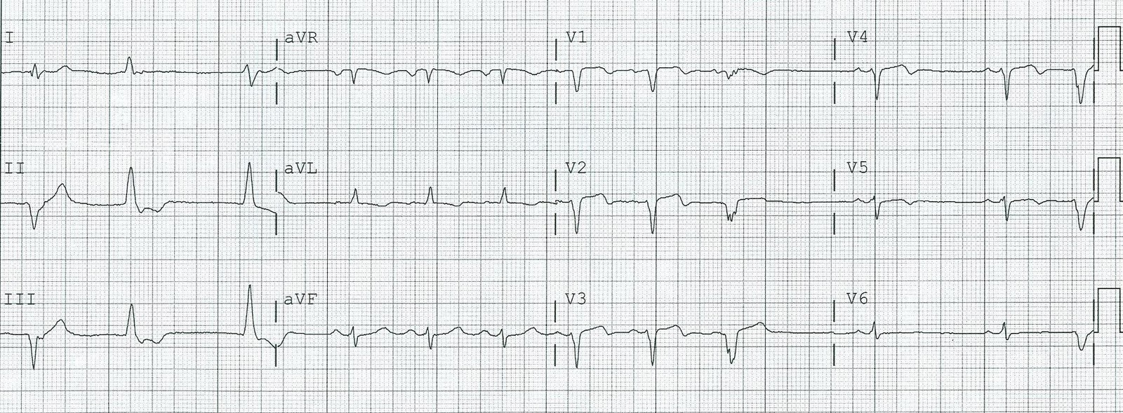 Dr. Smith's ECG Blog: Serial ECGs confirm initial suspicion of anterior ...