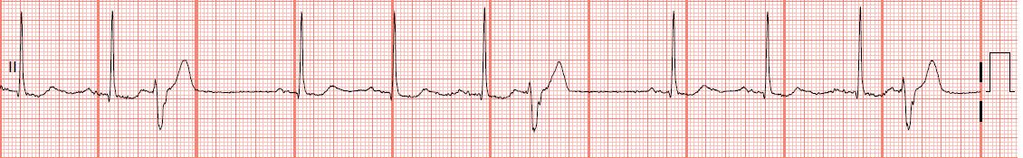 EKG Rhythm Strip Quiz 19