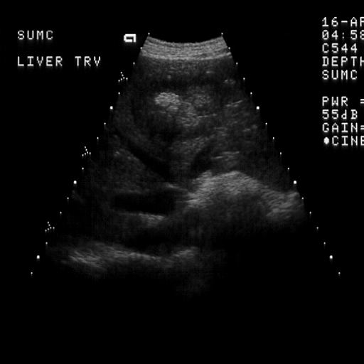 Doctor's knowledge: Calcified liver metastasis secondary to prostatic ...