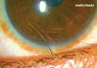 Disorders of Eyelids with pictures