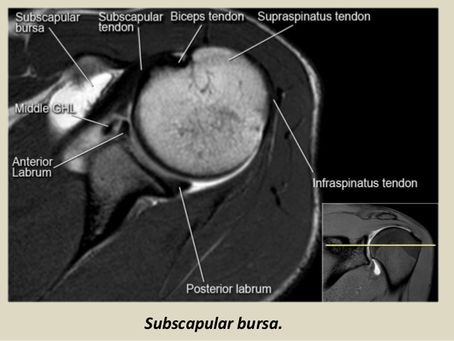 MRI Musculo-Skeletal Section: Bursa of shoulder.