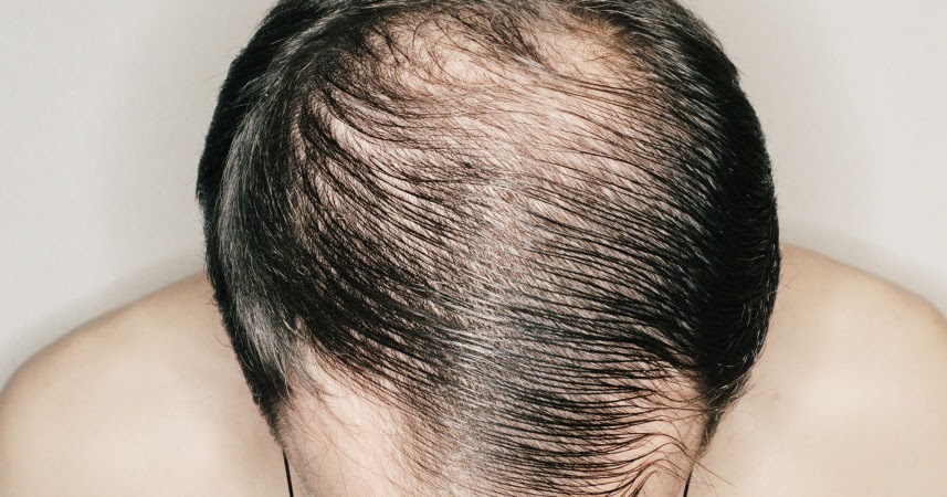 Solusi Hidup Sehat: 8 Cara Menumbuhkan Rambut Botak Secara Alami dan Cepat