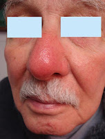 VIRTUAL GRAND ROUNDS IN DERMATOLOGY 2.0: The Rudolph Sign