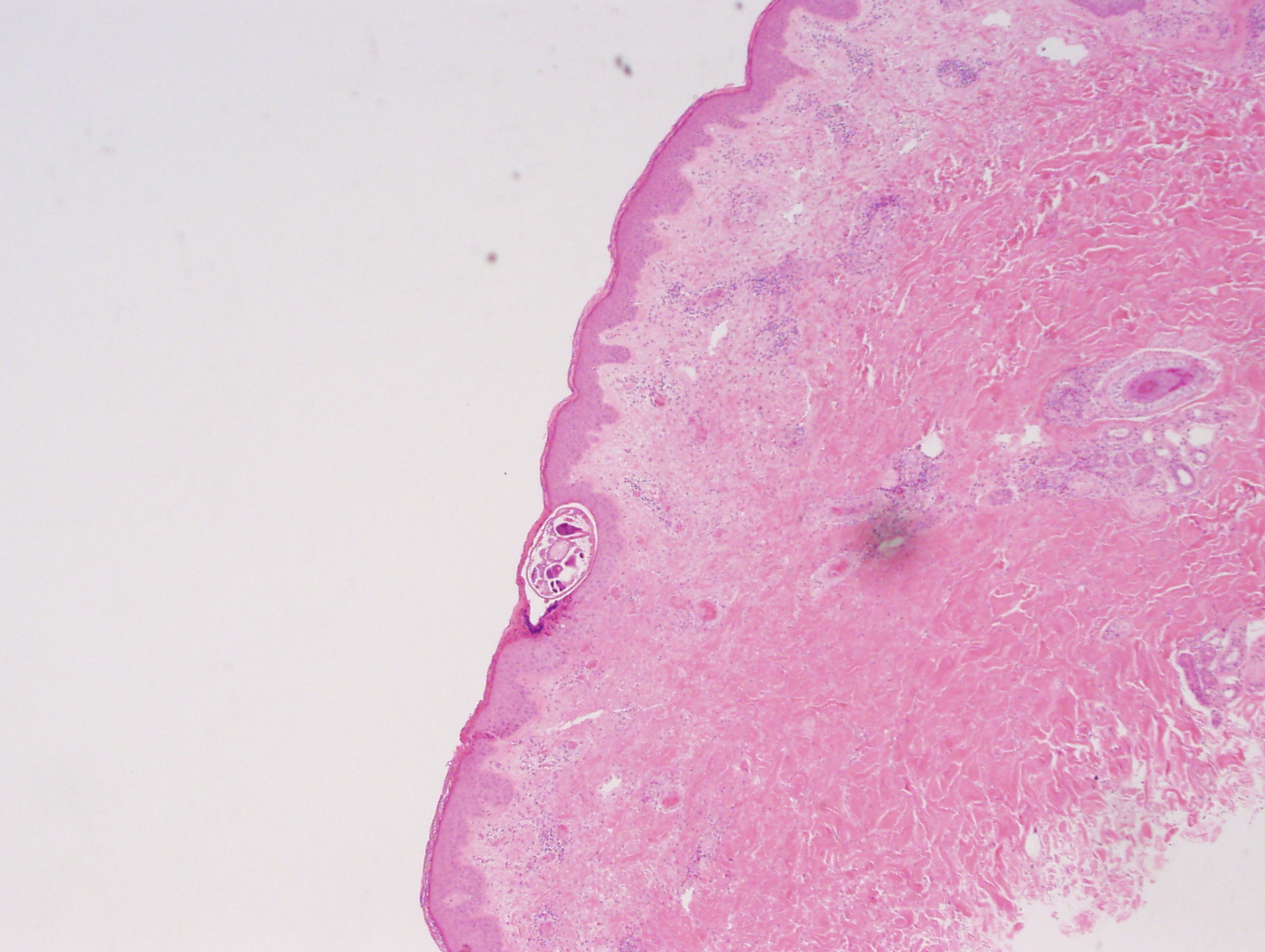 Cutaneous Larva Migrans Histology