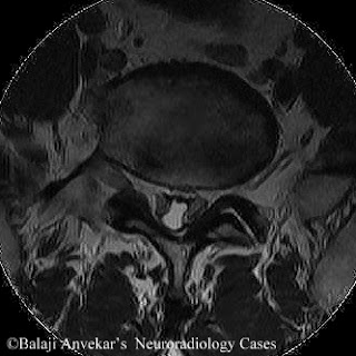 Dr Balaji Anvekar FRCR: Arachnoiditis MRI