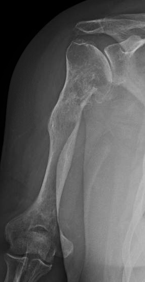 Shoulder Arthritis/Joint Replacement Rotator cuff tears: Managing a ...