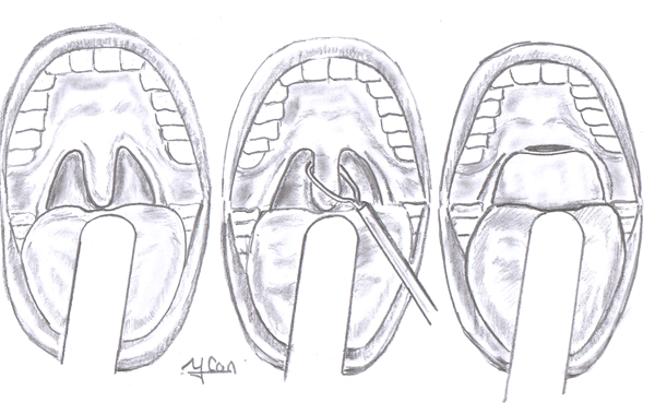 Uvula Nedir? - Özgün Bilge