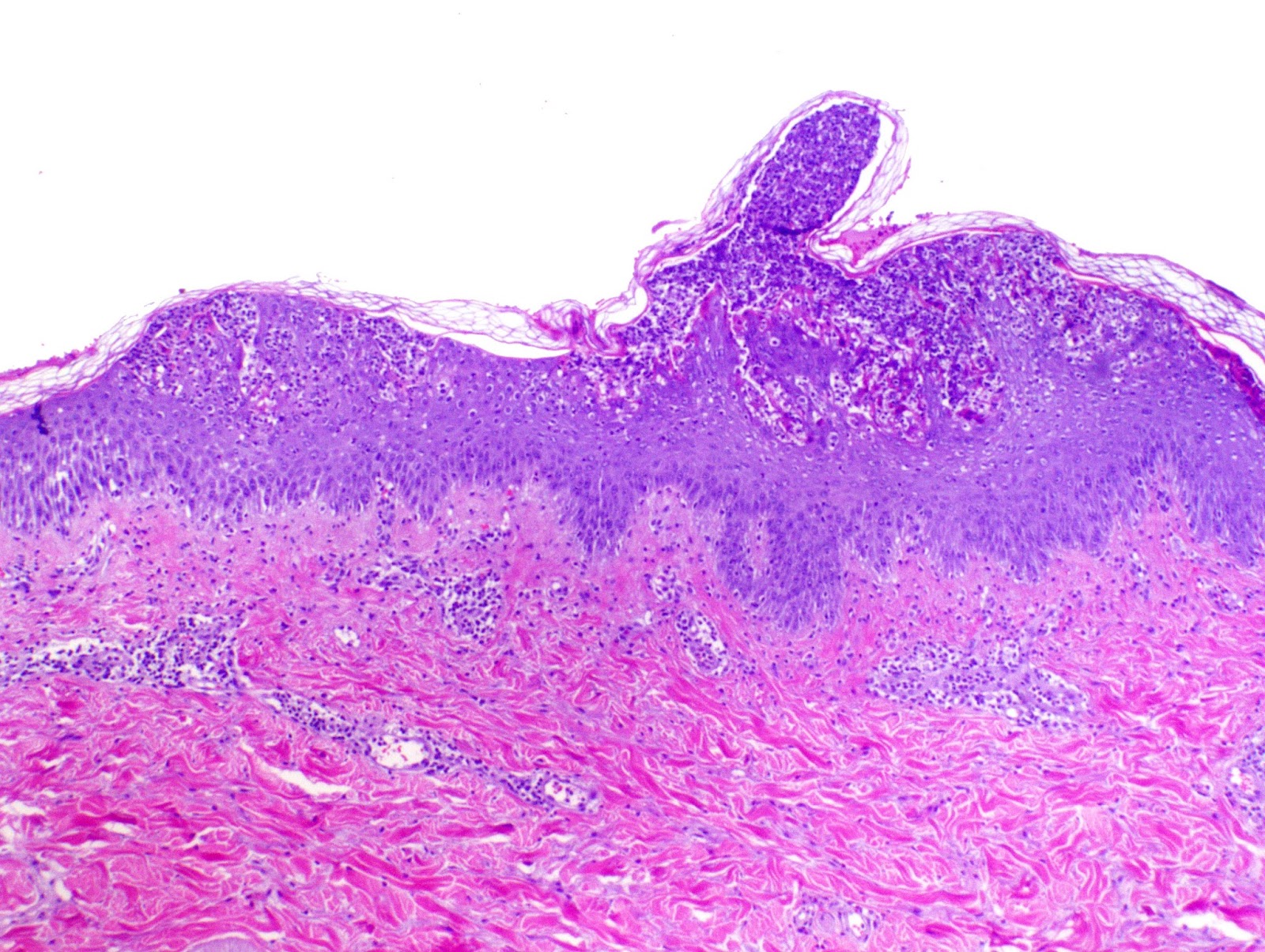 VIRTUAL GRAND ROUNDS IN DERMATOLOGY 2.0: Generalized Pustular Eruption ...