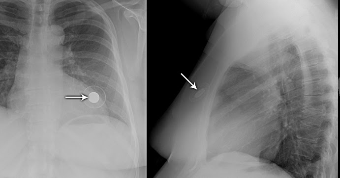 Roentgen Ray Reader: Breast Tissue Expanders and MRI