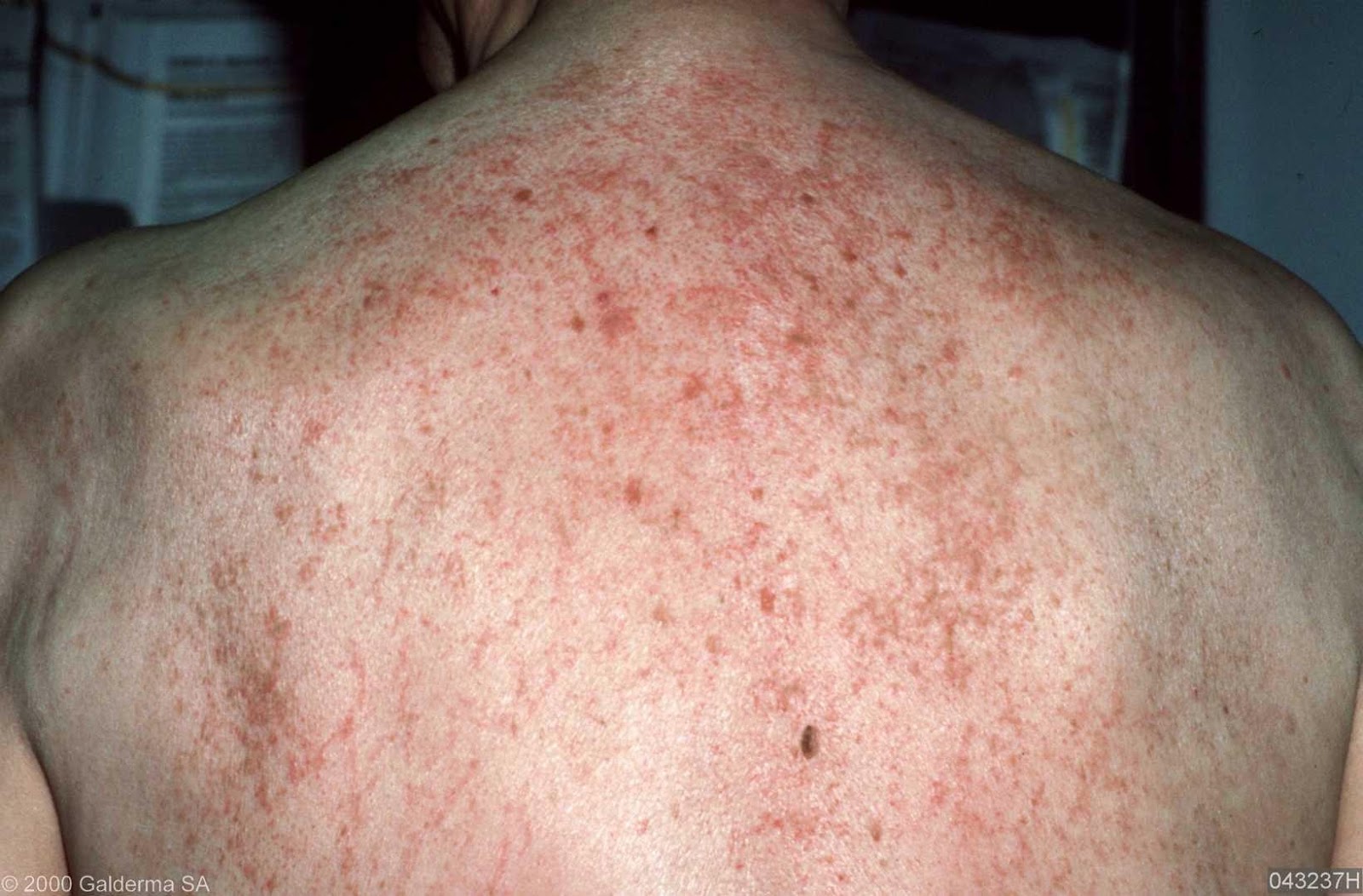 SKIN DISEASE TYPES: Seborrheic Dermatitis