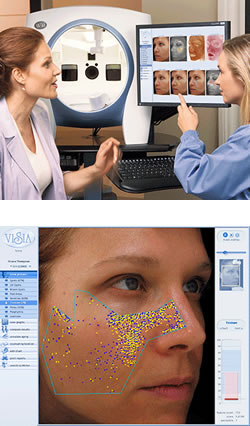 VISIA Complexion Analysis: VISIA Complexion Analysis