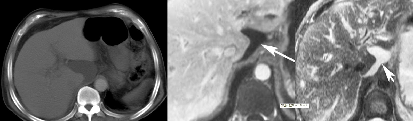 POINT OF VIEW: DX: Biloma secondary to Gangrenous cholecystitis