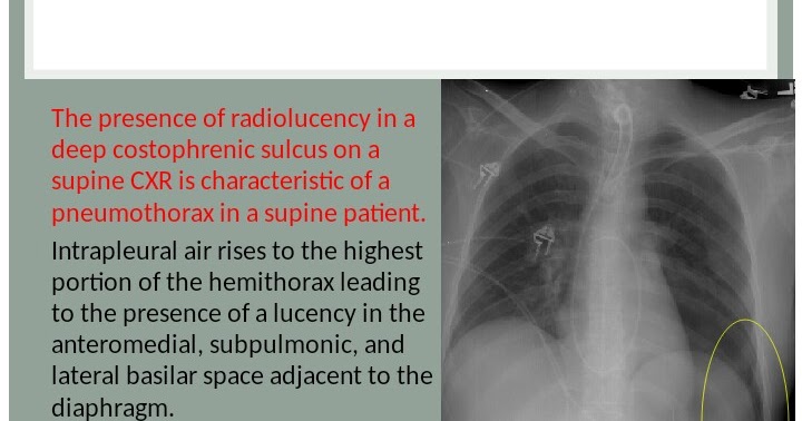 Chest Medicine Made Easy-Dr Deepu: Deep Sulcus Sign