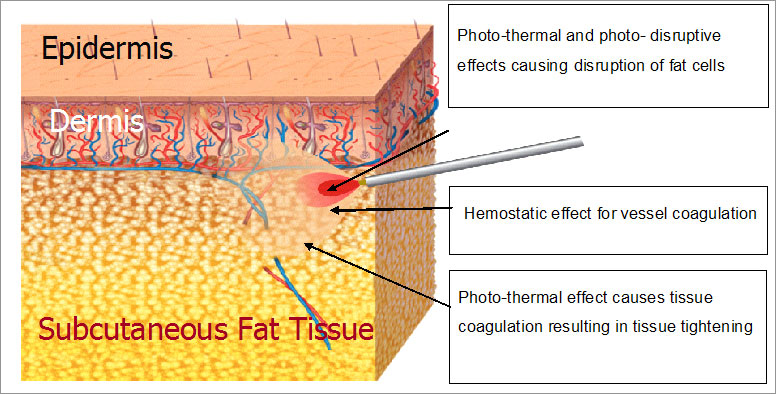 DermaSphere: Laser Assisted Liposuction