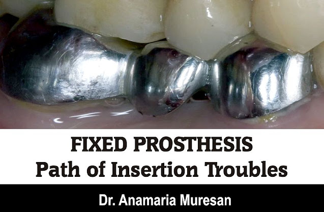 FIXED PROSTHESIS: Dealing with Path of Insertion Troubles - Dr ...