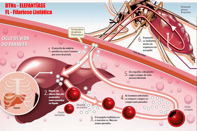Doenças Raras Doem®: DTNs - FL - Filariose Linfática ou Doença ...