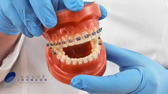 Quest Johnson Orthodontics: 2 Common Bites in Orthodontics