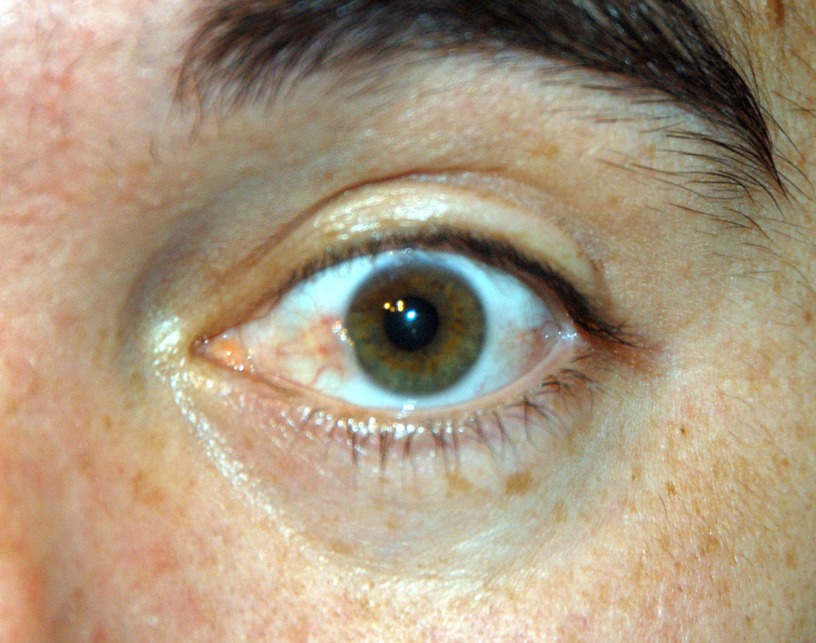 Pterygium Symptoms, Signs, Treatments, Recovery: February 2012