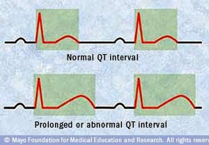 Tom's Physiotherapy Blog: Long QT Syndrome and Sudden Cardiac Deaths