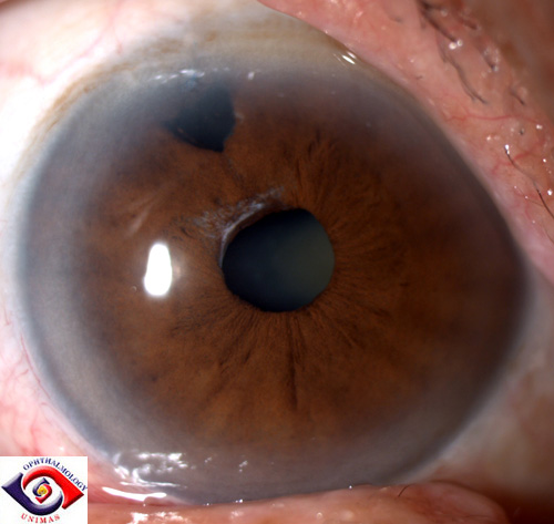 my eyes is the mirror of my heart: Eye surgery