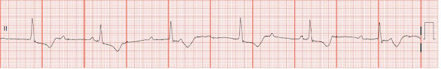 Float Nurse: EKG Rhythm Strip Quiz 52: Heart Blocks