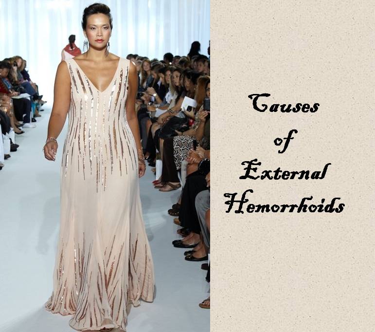 External Hemorrhoids - GARDEN