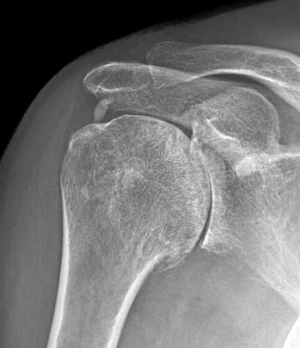 Shoulder Arthritis / Rotator Cuff Tears / Shoulder Pain : Is there such ...