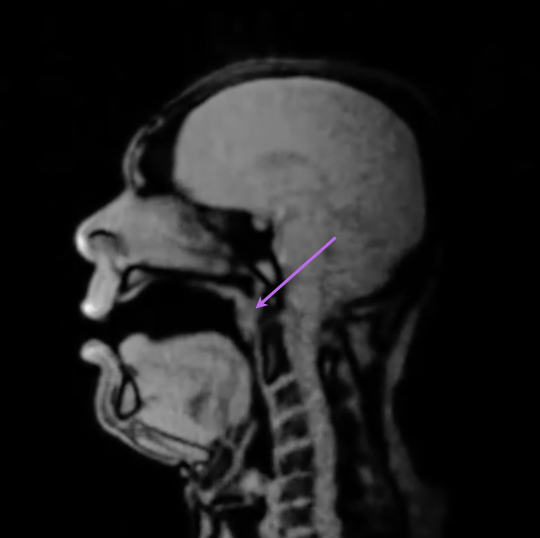 Velopharyngeal Insufficiency (VPI) After UPPP or Uvula Excision Surgery ...