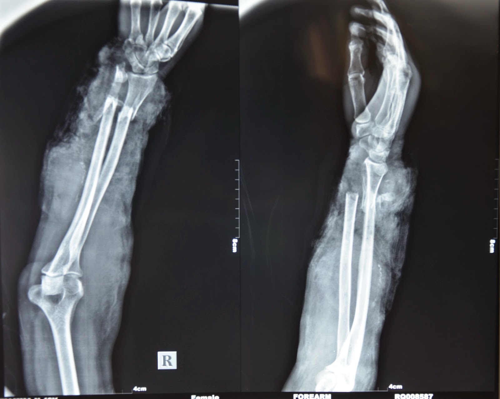 Crush Injury Vs Fracture at Edward Padgett blog
