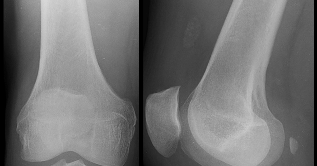 Radiology Archives: Κυαμoειδές Οστάριο (Fabella)