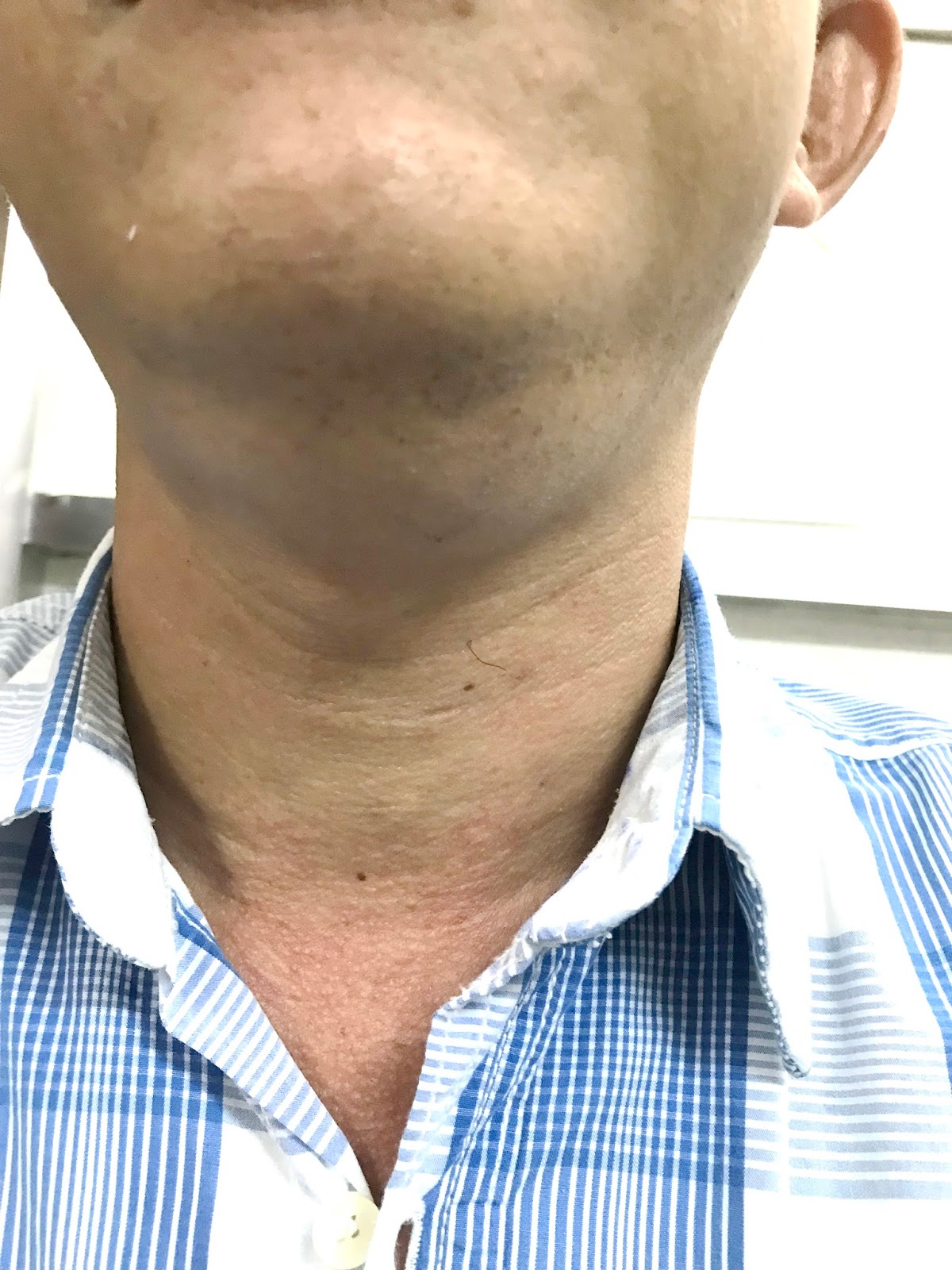 VIETNAMESE MEDIC ULTRASOUND: CASE 467: SUBMANDIBULAR MASS, Dr PHẠM THỊ ...