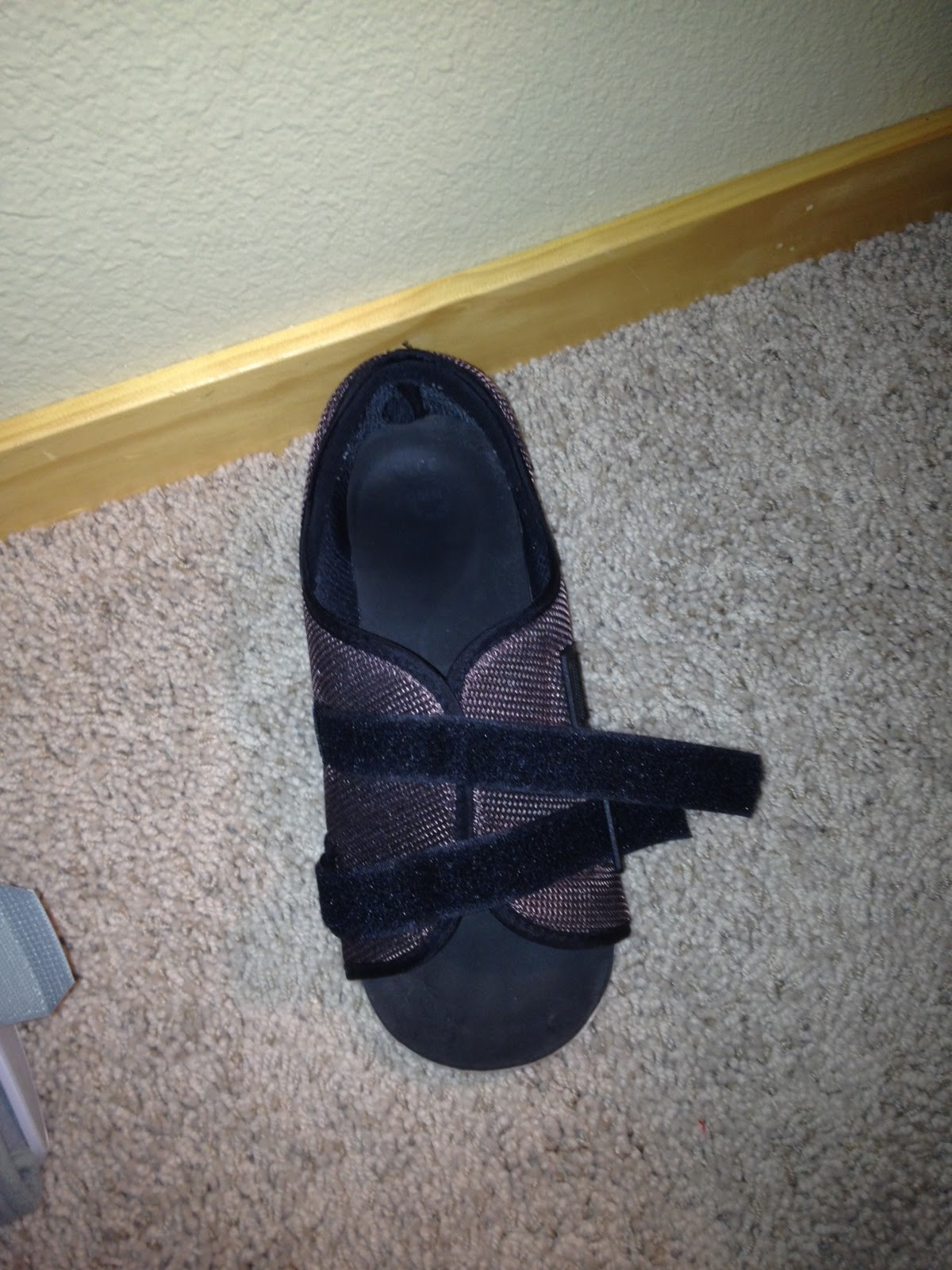 Downs Bunion Surgery 11.17.2011 Hallux Valgus Deformity with Metatarsal ...