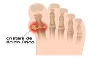 A gota é uma doença reumática que geralmente afeta as articulações ...