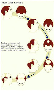 AGA-Male Pattern Baldness