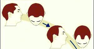 AGA-Male Pattern Baldness