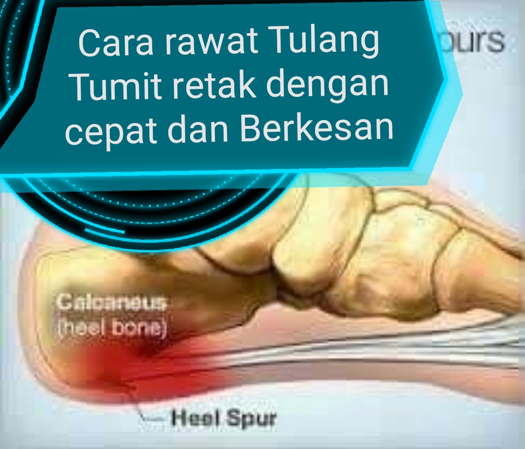 Cara rawat tulang tumit retak dengan Cepat dan Berkesan tanpa Pembedahan