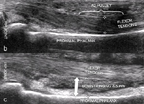 Tom's Physiotherapy Blog: Pulley Injuries: updated