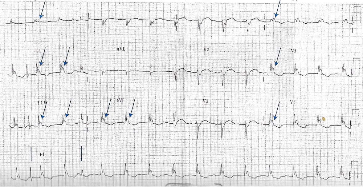 CARDIOGUS: Electrocardiograma de la semana: Ondas J de Osborn
