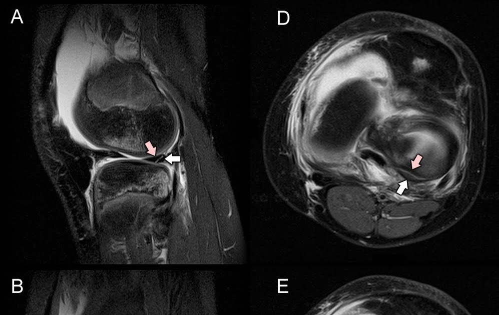 Roentgen Ray Reader: Wrisberg Rip